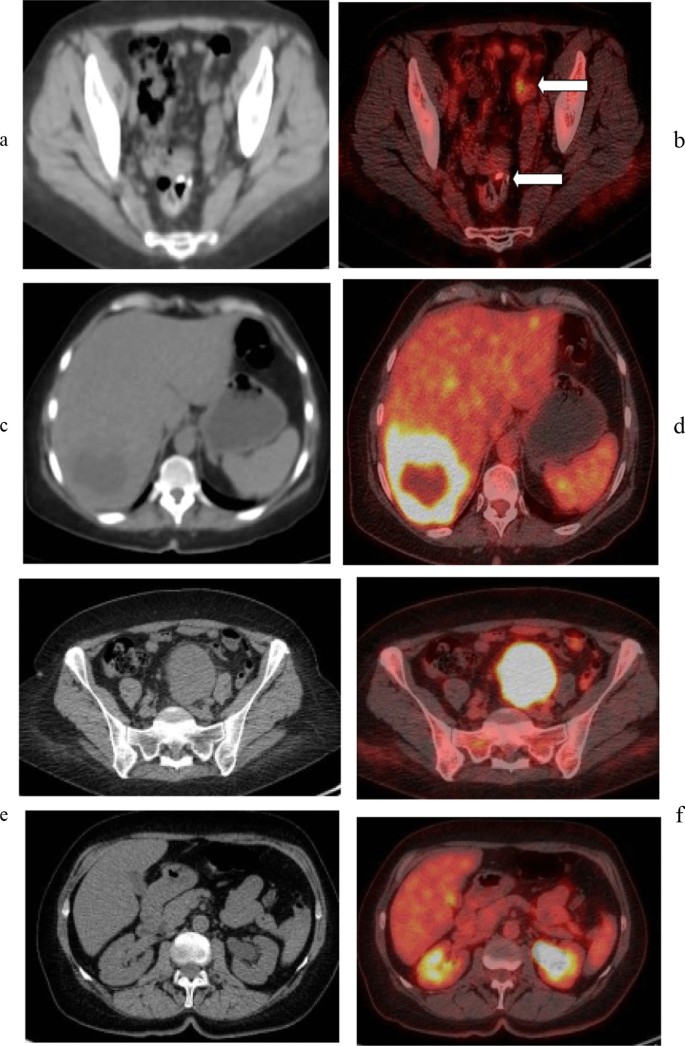 Whole Body PET Scan For Cancer